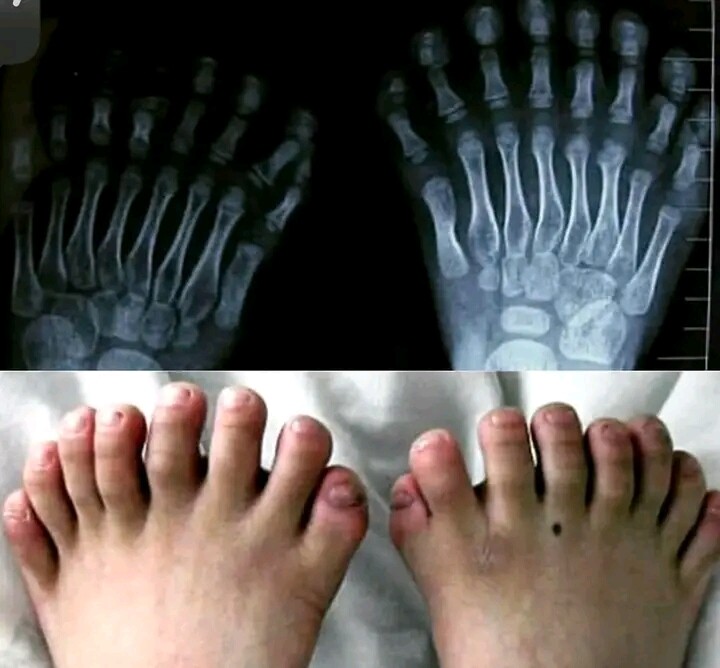Congenital asymmetric Bilateral Polydactyl of feet - General - Kenya Talk